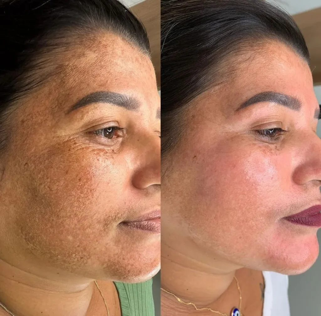 Pigmentation & Melasma Treatment in Harrow | MedCura Clinic