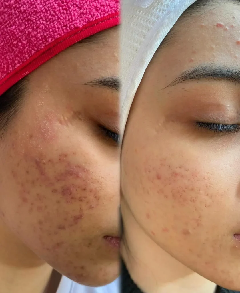 Facials in Harrow | Deep Skin Cleansing & Hydration MedCura