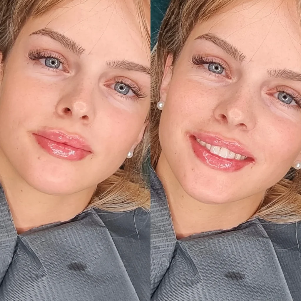 Dermal Fillers in Harrow | Medcura Clinic