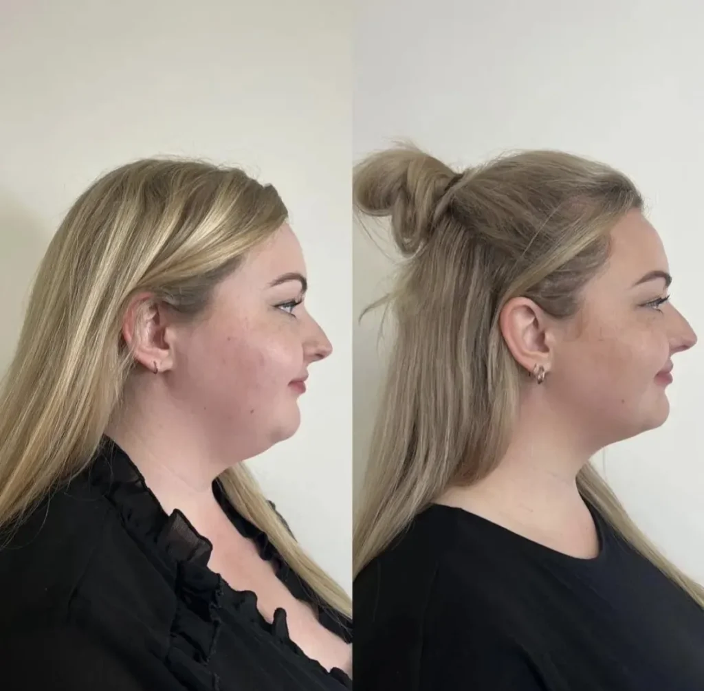 Fat Dissolving Injections - Medcura Stanmore