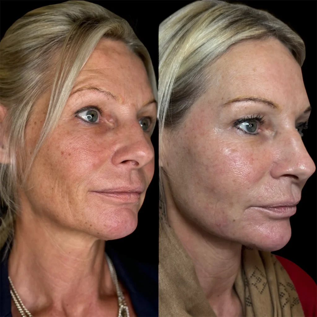 Ultimate Liquid Face Lift - Medcura Stanmore