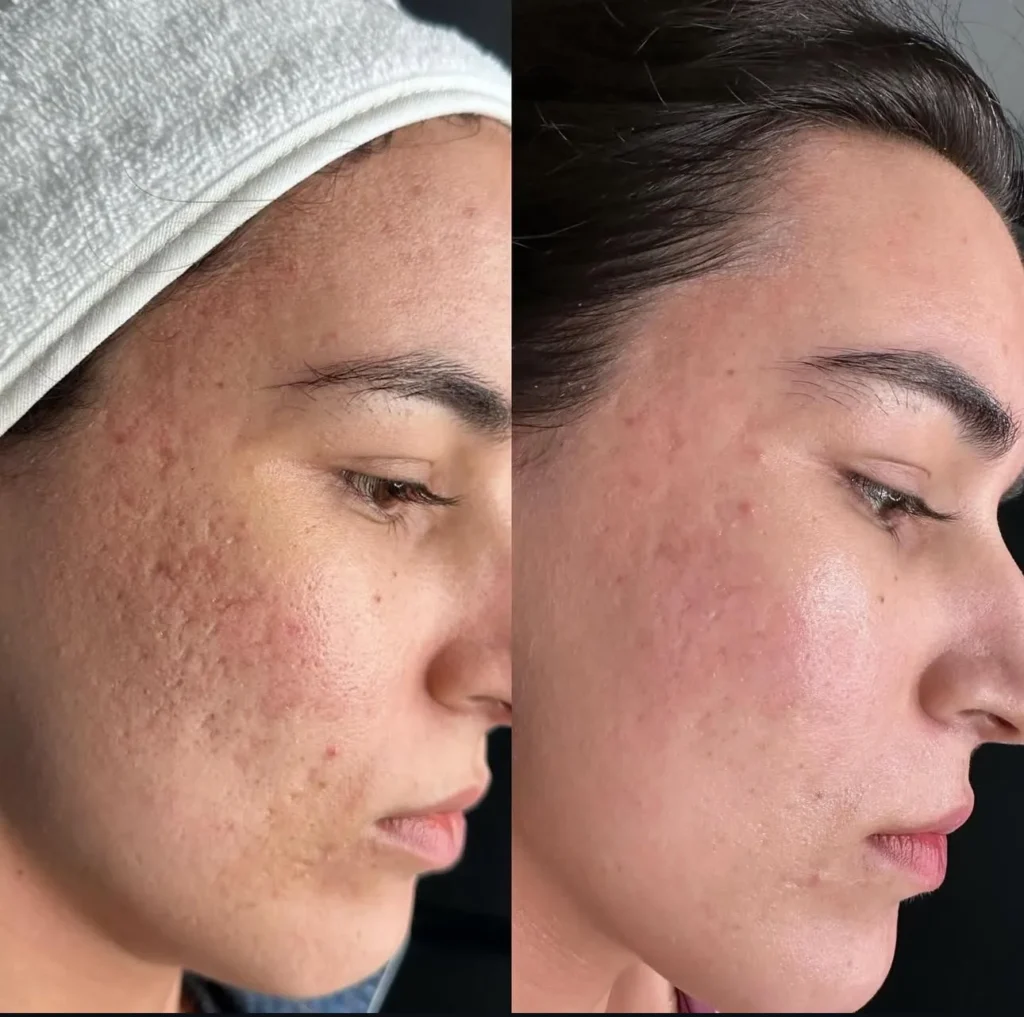Scarology for Acne Scars - Medcura Stanmore