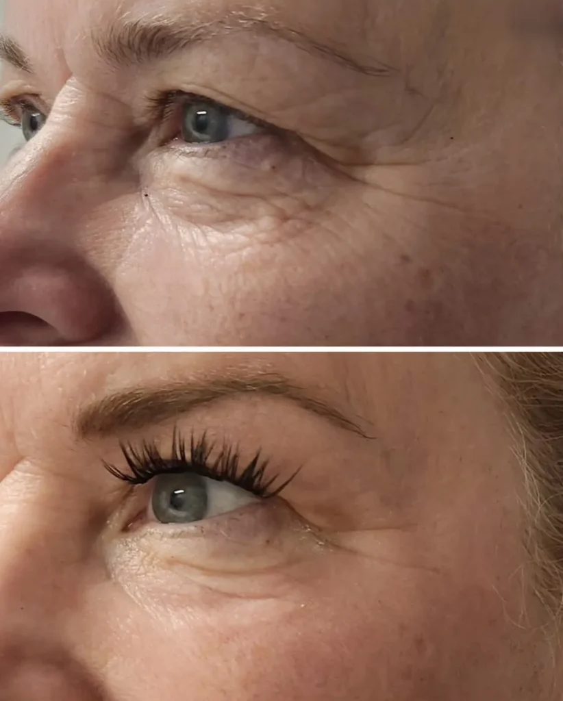 Co2 Laser Treatment Harrow - Medcura