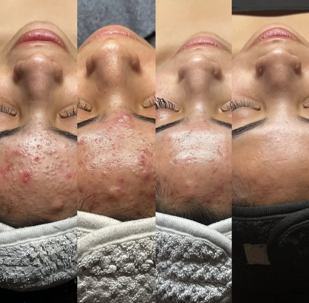 Acne Scar Treatment in Harrow | Medcura Skin Experts